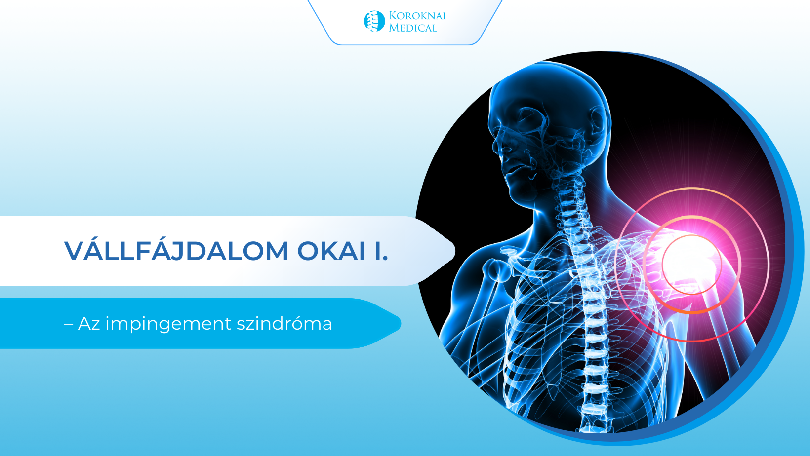 Vállfájdalom okai I. - Az impingement szindróma - Koroknai Medical